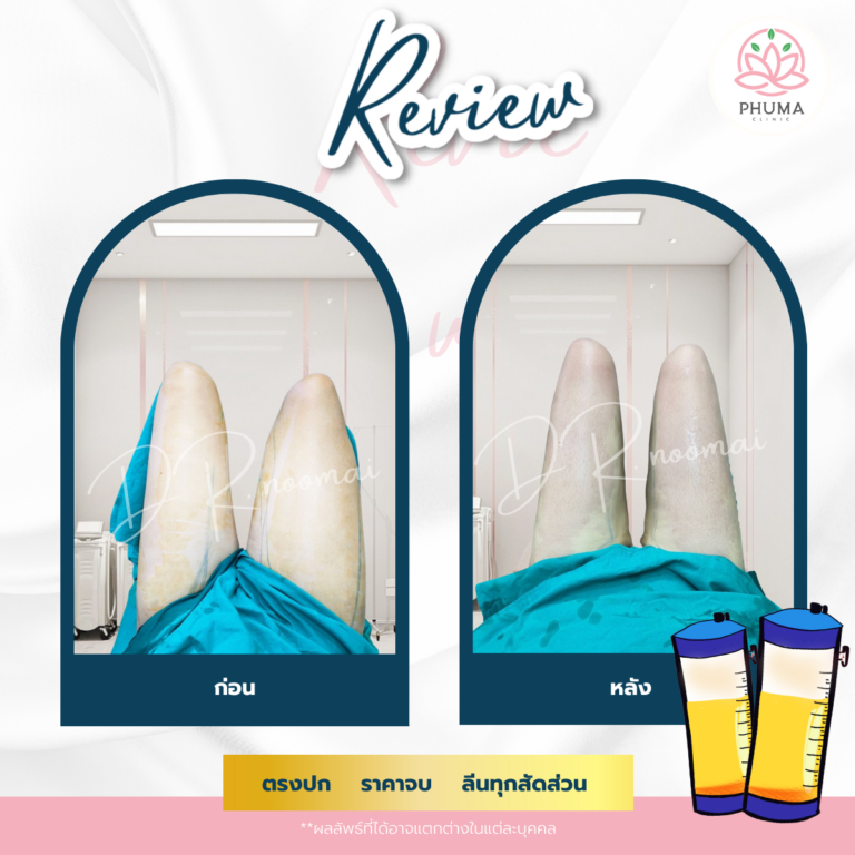 Phuma clinic ดูดไขมัน เติมไขมันหน้า ปรับรูปหน้า แผลเล็ก เจ็บน้อย (หมอ ...