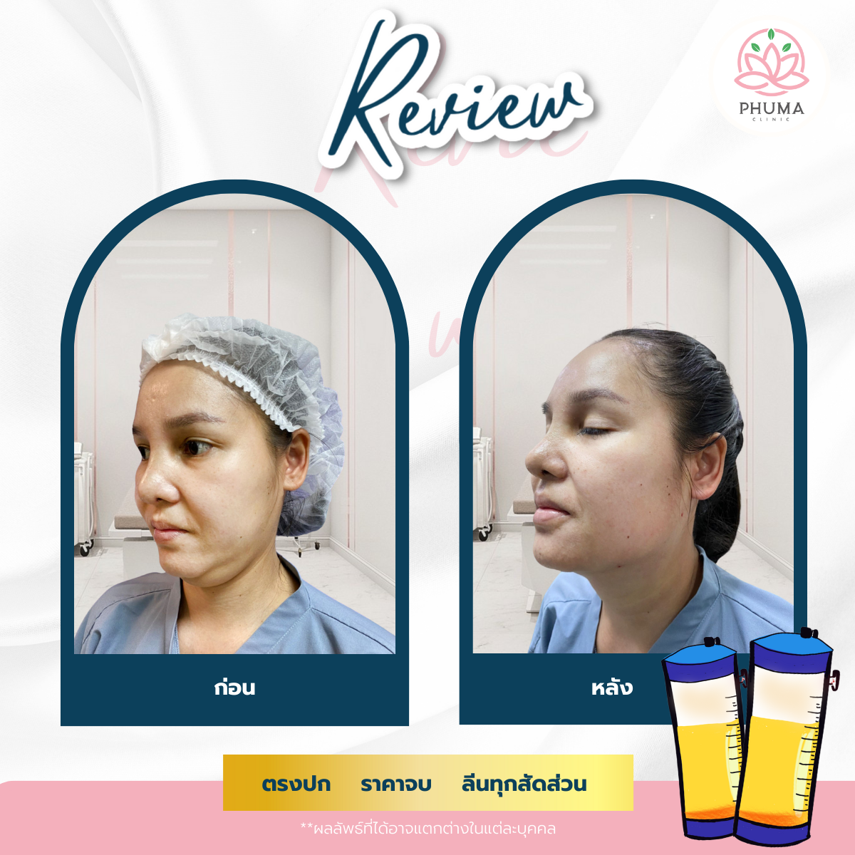 รีวิวดูดไขมัน เหนียง แก้ม หน้าV ที่ Phuma clinic