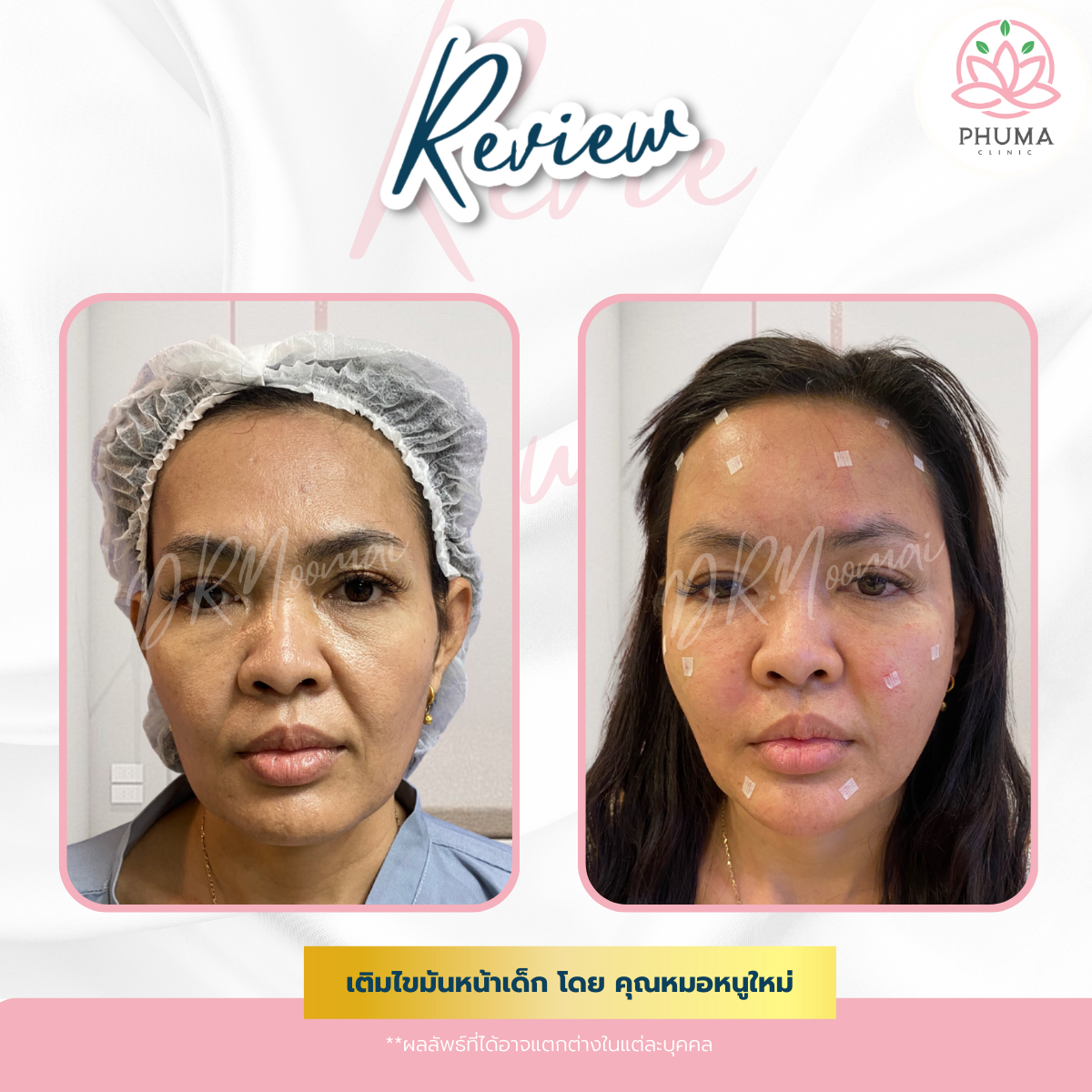 รีวิวเติมไขมันหน้า หน้าเด็ก อ่อนเยาว์ เต่งตึง ที่ Phuma clinic หมอหนูใหม่