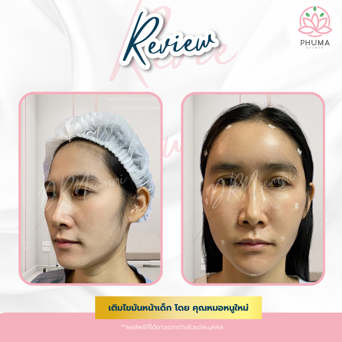 รีวิวเติมไขมันหน้า หน้าเด็ก อ่อนเยาว์ เต่งตึง ที่ Phuma clinic หมอหนูใหม่