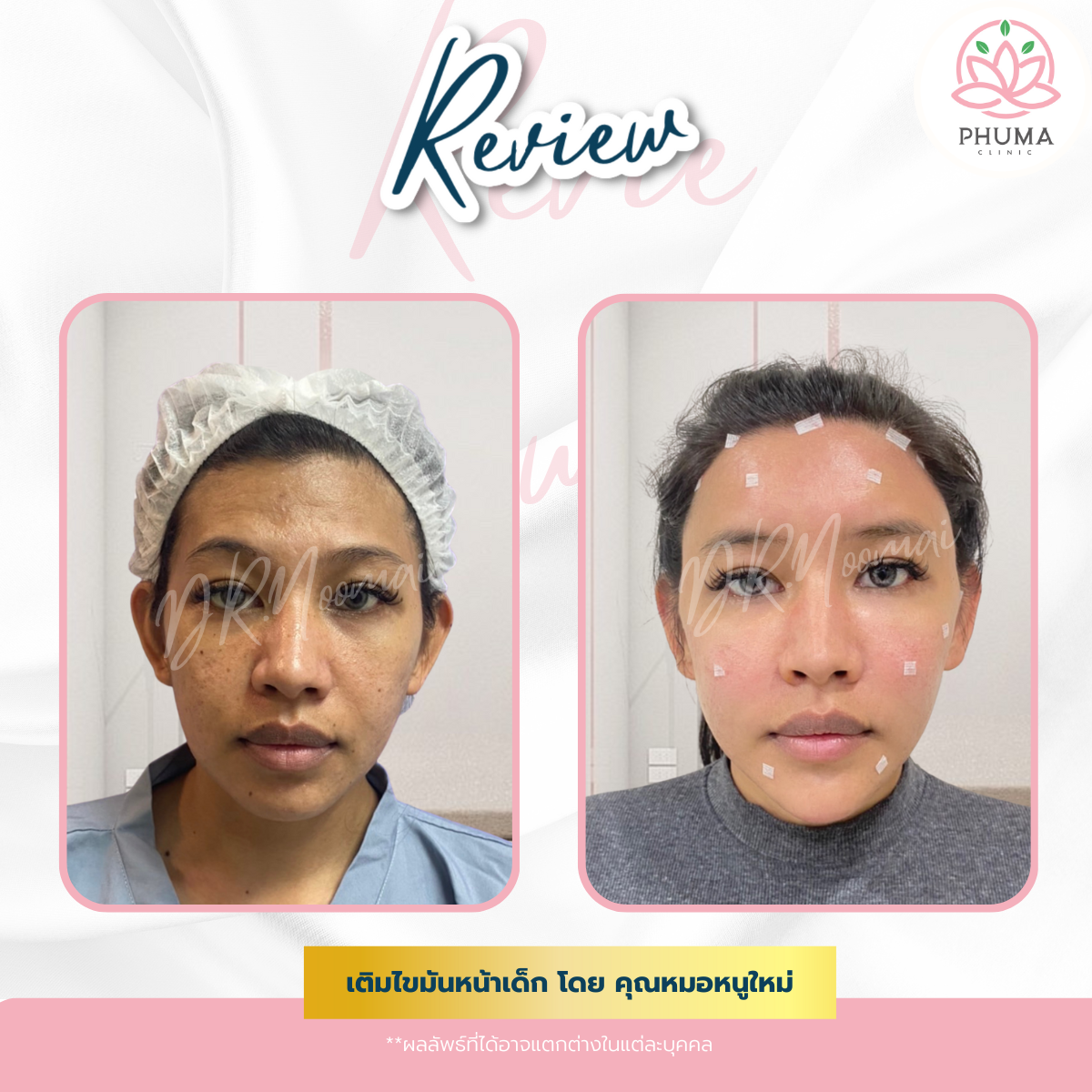 รีวิวเติมไขมันหน้า หน้าเด็ก อ่อนเยาว์ เต่งตึง ที่ Phuma clinic หมอหนูใหม่