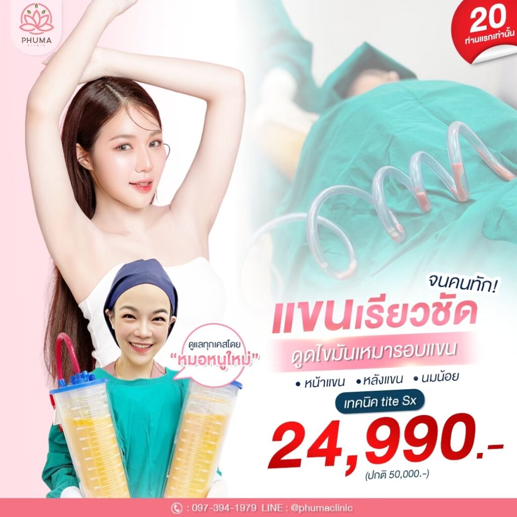 ดูดไขมันต้นแขน แขนเล็ก แขนเรียว เทคนิคเฉพาะที่ Phuma clinic (หมอหนูใหม่)