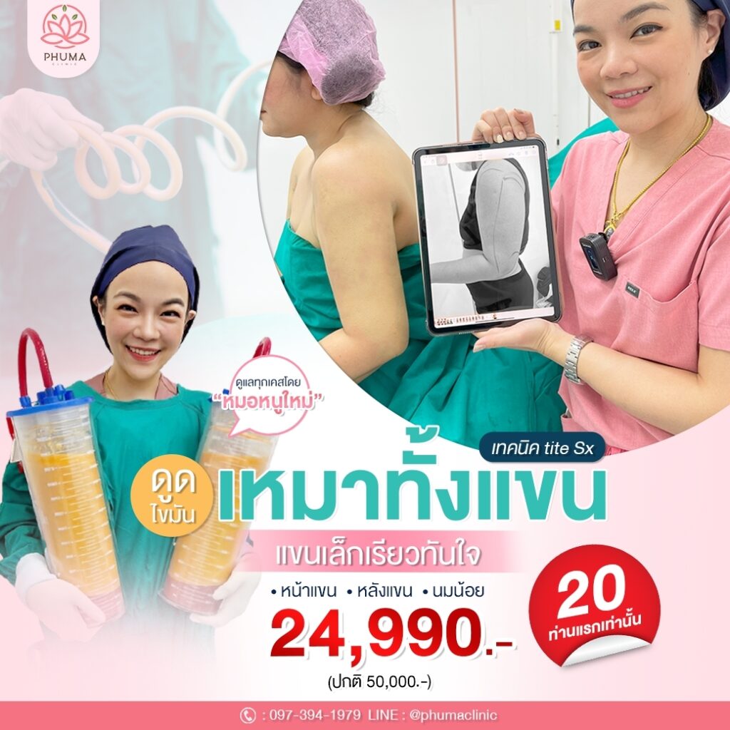 ดูดไขมันต้นแขน แขนเล็ก แขนเรียว เทคนิคเฉพาะที่ Phuma clinic (หมอหนูใหม่)