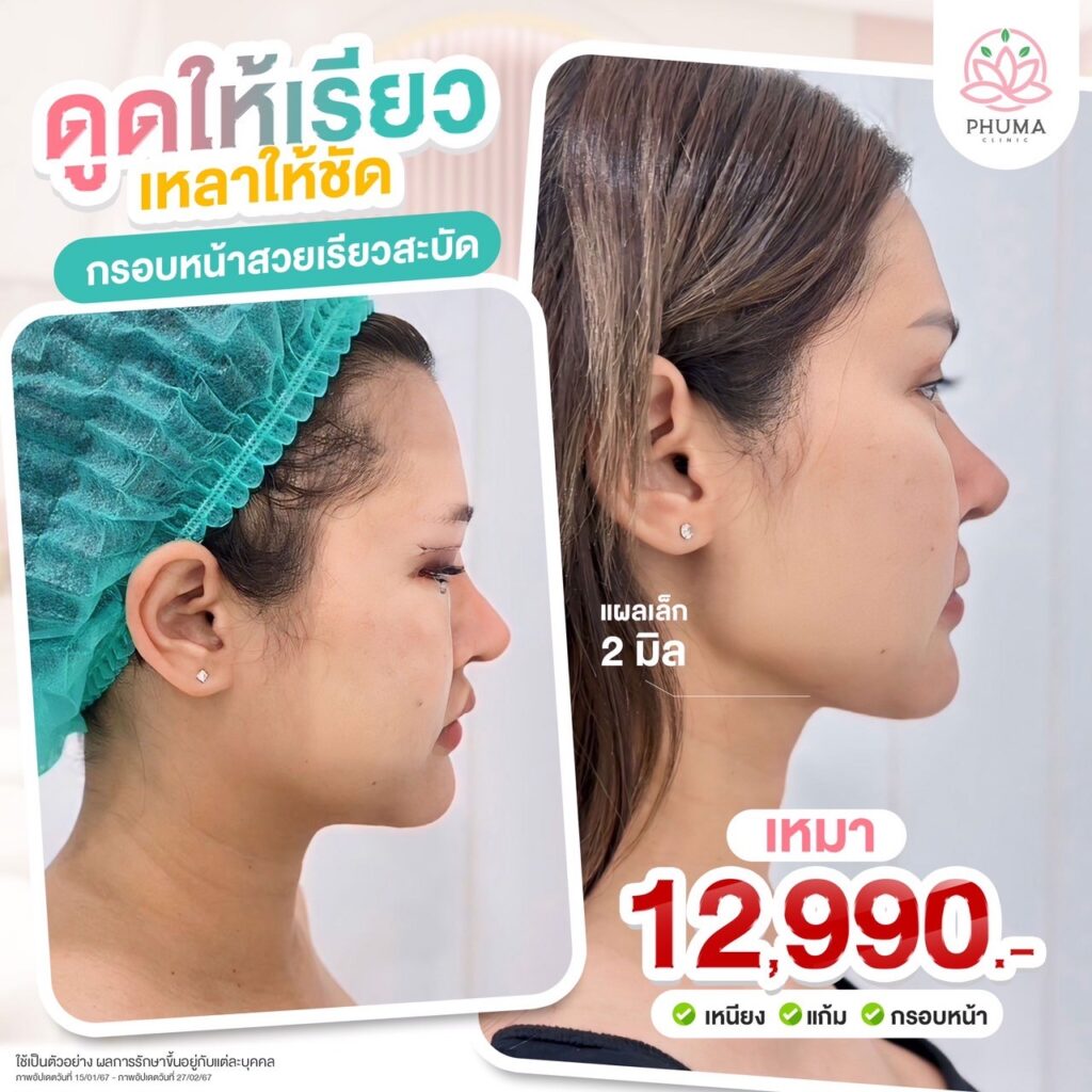 Phuma clinic ดูดไขมัน เติมไขมันหน้า ปรับรูปหน้า แผลเล็ก เจ็บน้อย (หมอ ...